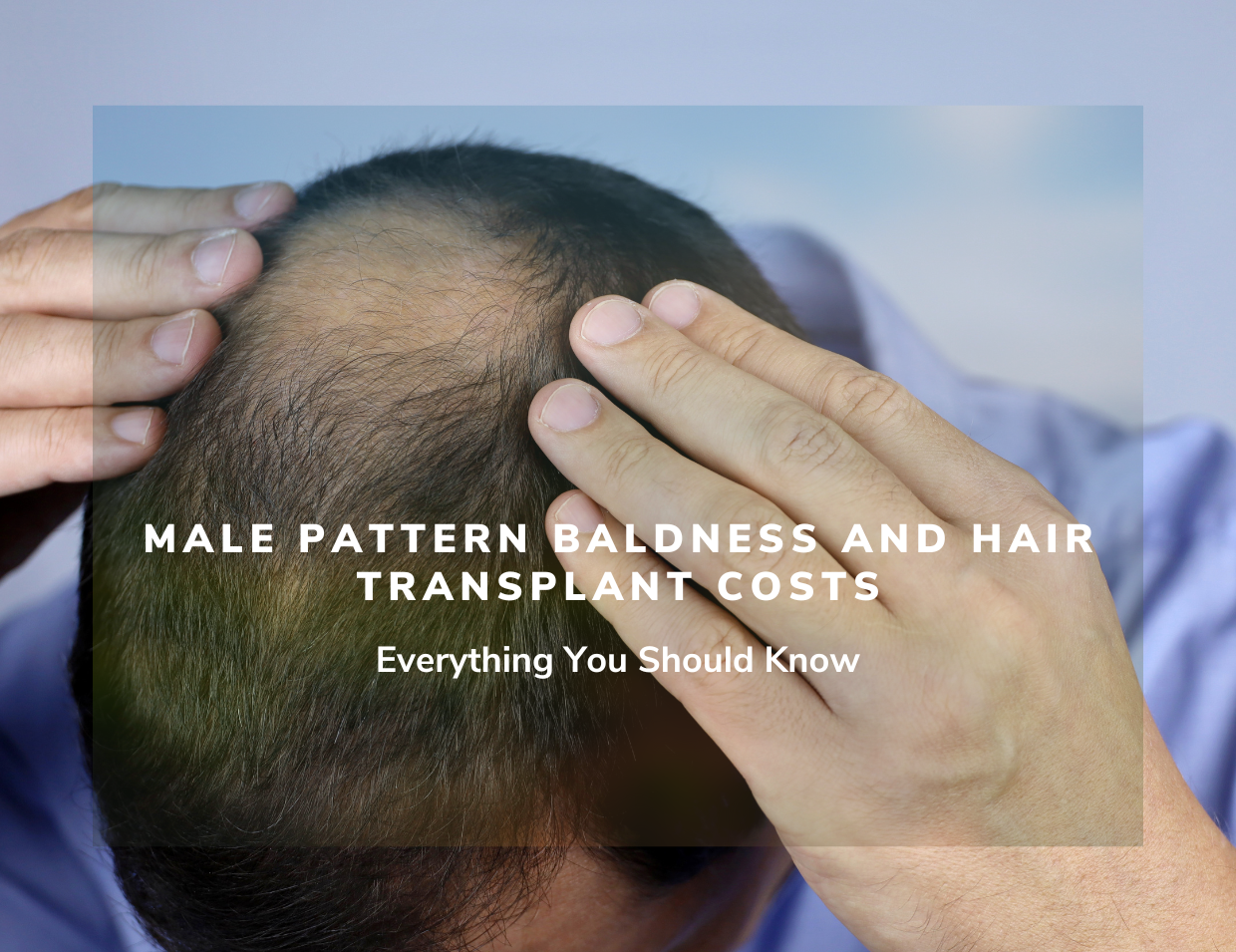 Male Pattern Baldness & Hair Transplant Costs Explained